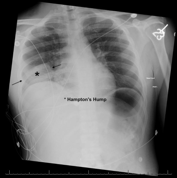 Exam 3 | PANCE and PANRE Practice Exam